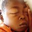 Nephrotic syndrome - Differential Diagnosis - Management ...