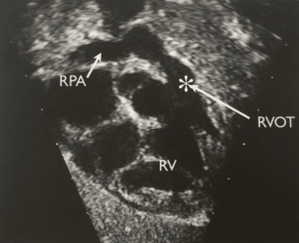 Tetralogy of Fallot- Pathophysiology -Managment- TeachMePaediatrics