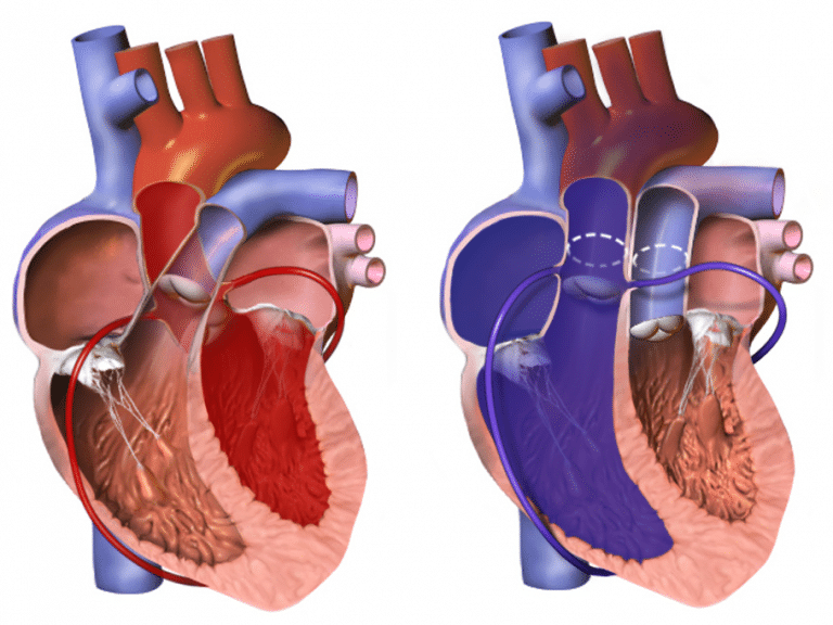 Transposition of the Great Arteries - Presentation - TeachMePaediatrics