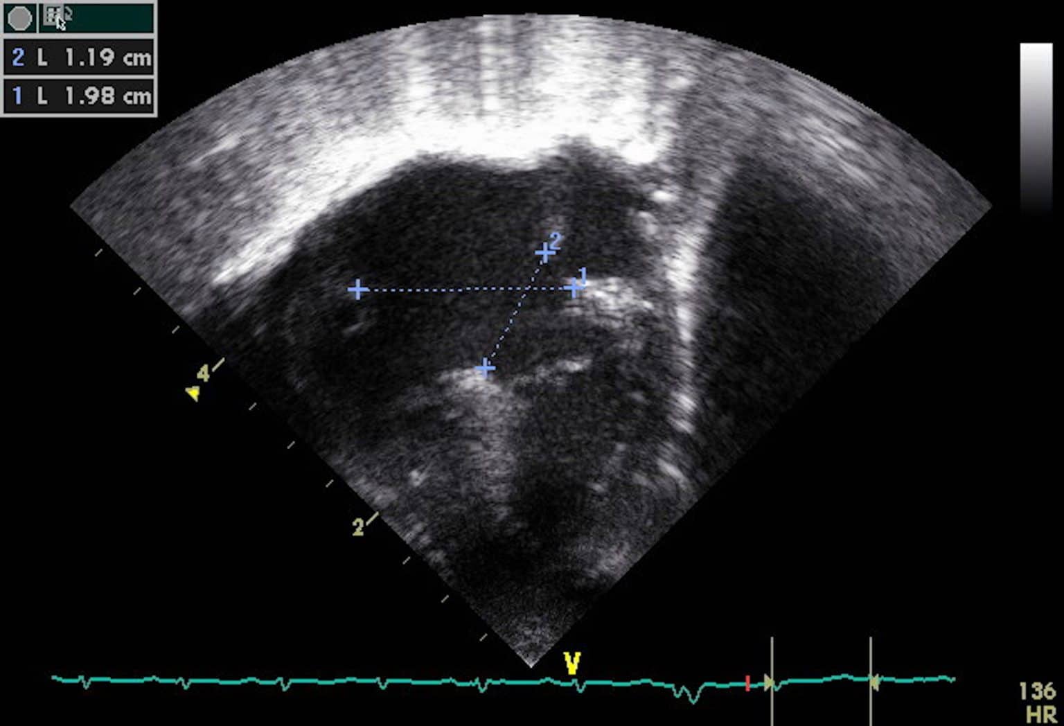 Atrioventricular Septal Defects (AVSD) - TeachMePaediatrics