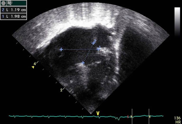 Atrioventricular Septal Defects (AVSD) - TeachMePaediatrics