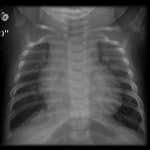 Atrioventricular Septal Defects (AVSD) - TeachMePaediatrics