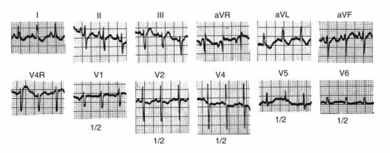 Tricuspid Atresia Pathophysiology Management Teachmepaeds