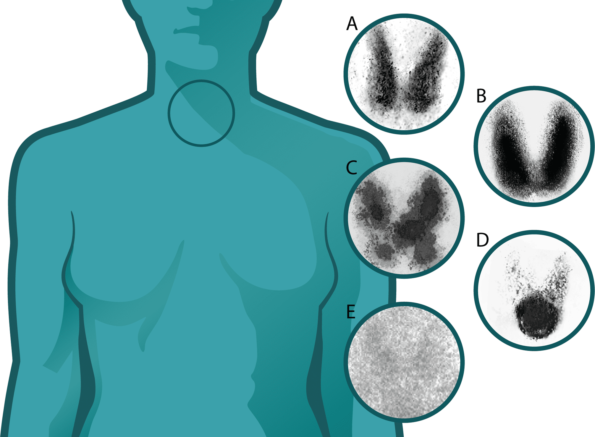 Hyperthyroidism - TeachMePaediatrics