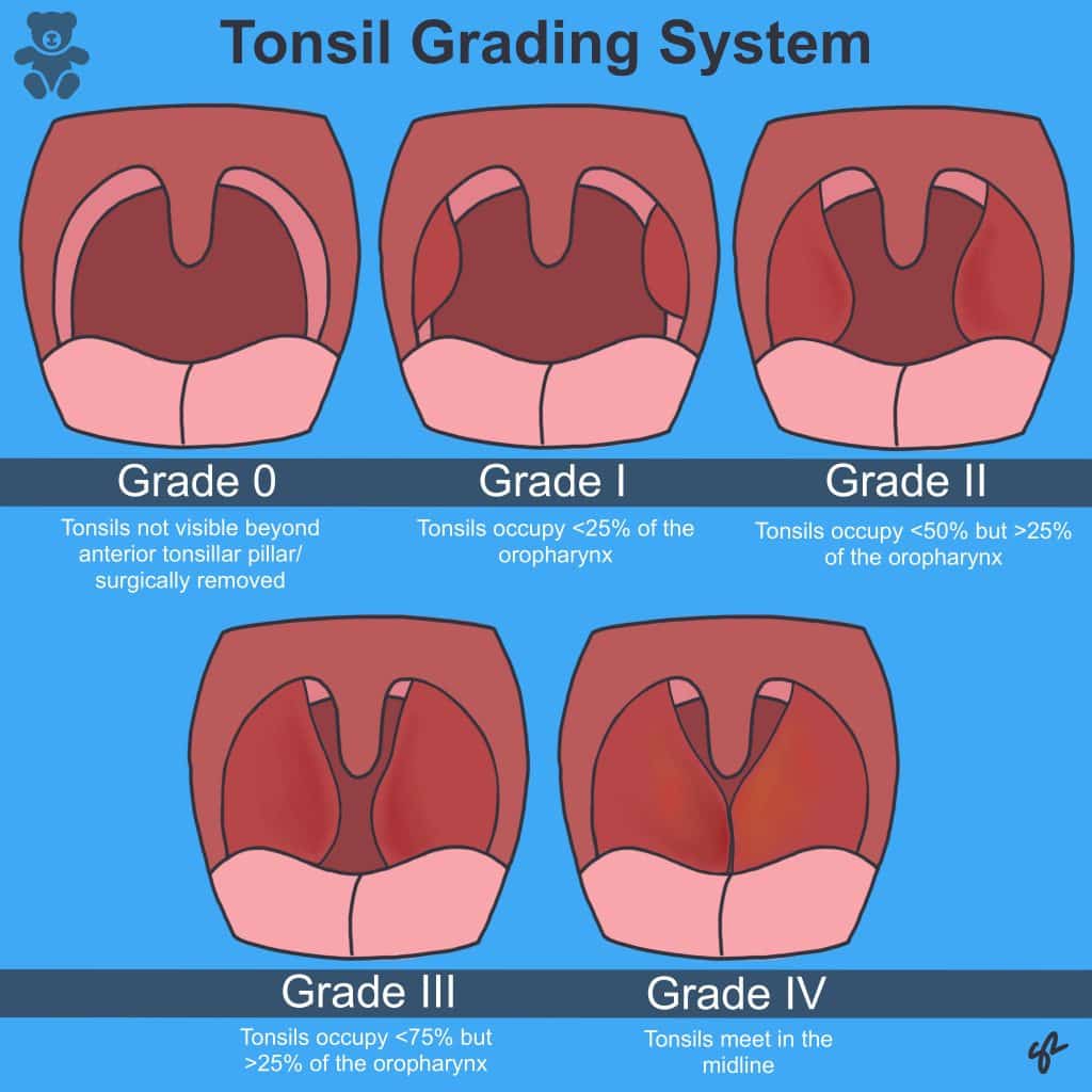 Tonsillitis Clinical Features Management TeachMePaediatrics Tonsillitis Clinical Features Management TeachMePaediatrics