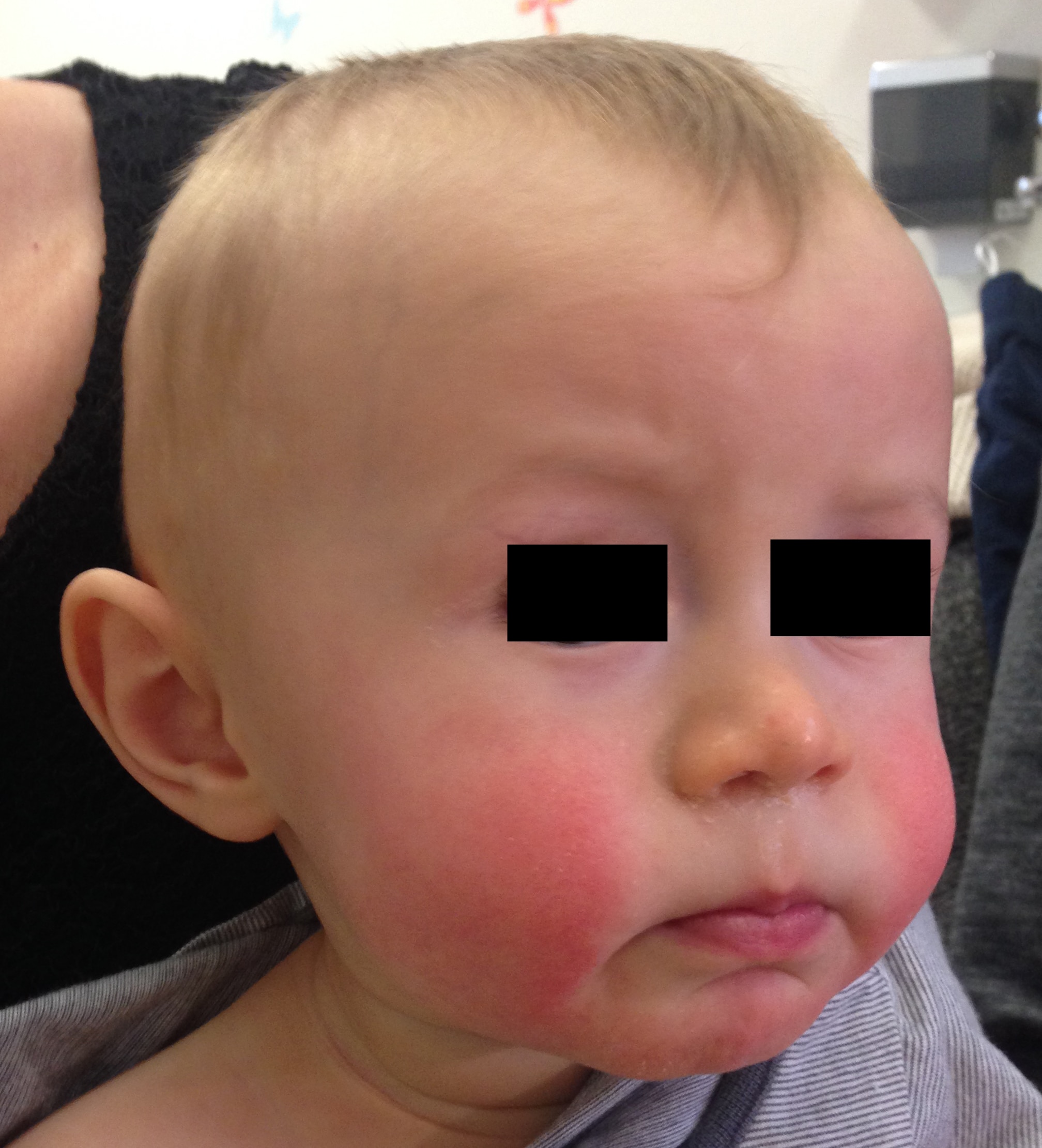 Childhood Rashes - TeachMePaediatrics