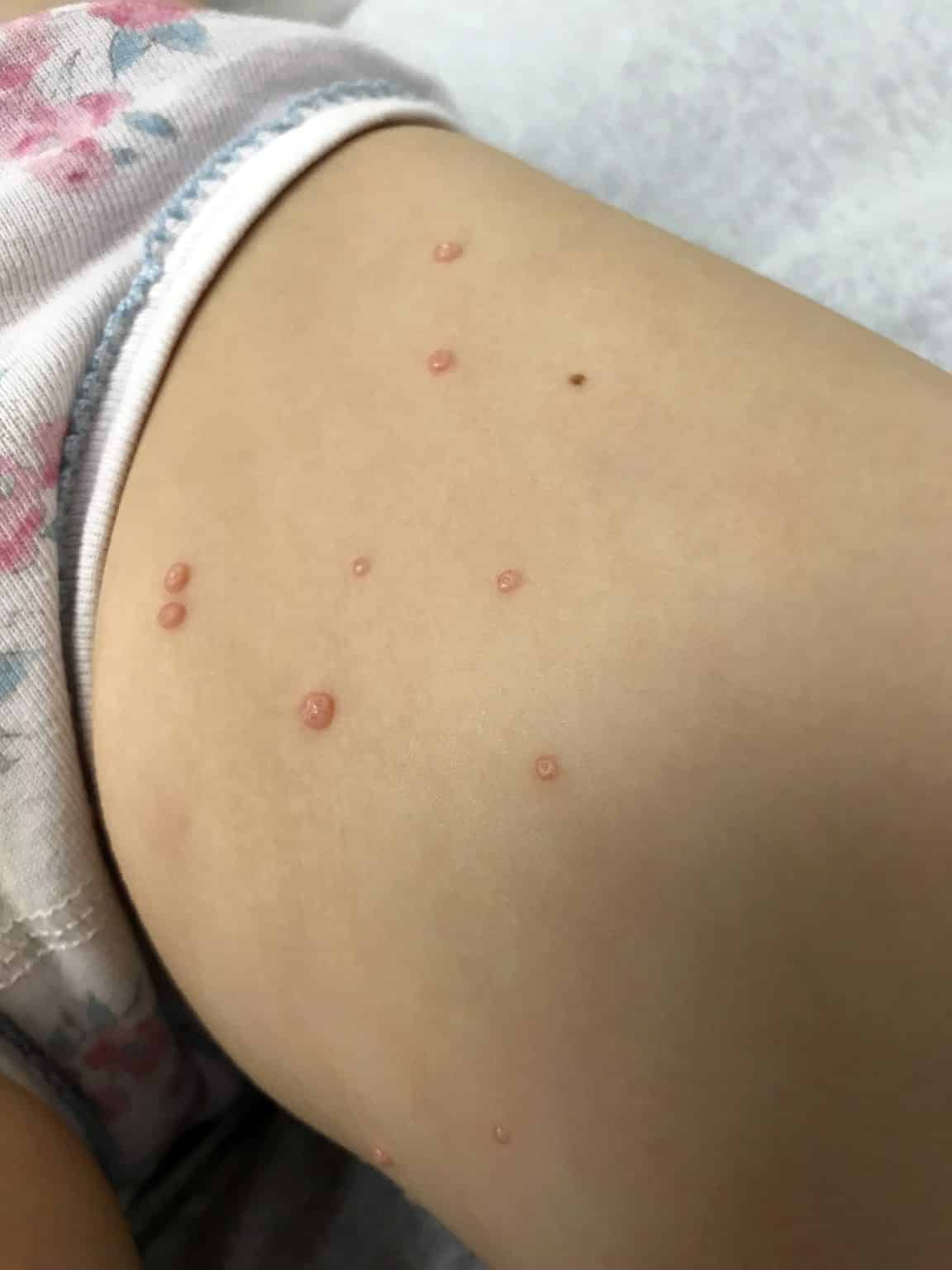 Childhood Rashes - TeachMePaediatrics