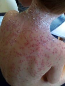 Childhood Rashes - TeachMePaediatrics