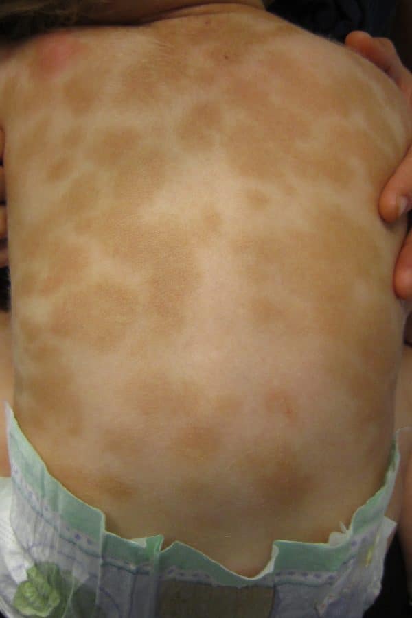 Childhood Rashes - TeachMePaediatrics