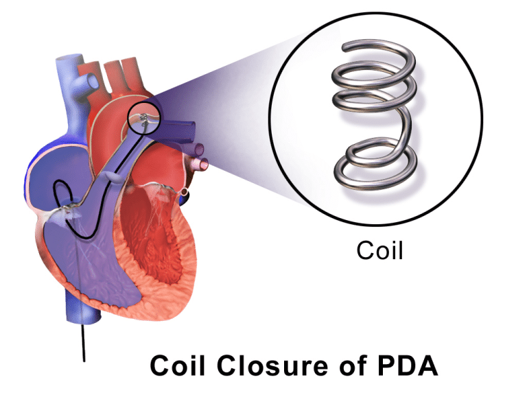 Patent Ductus Arteriosus - TeachMePaediatrics